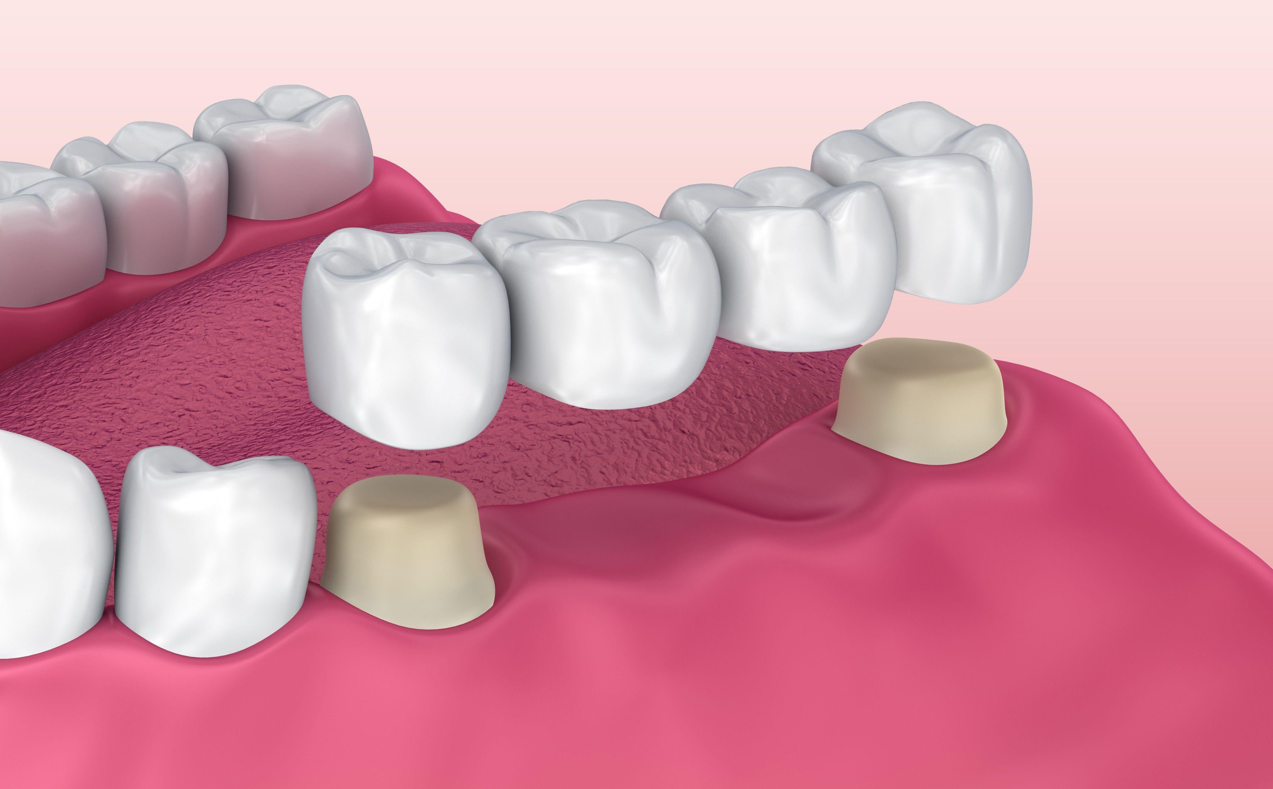 Qu'est-ce qu'un pont dentaire ? Types, coûts et prévention | Oclean